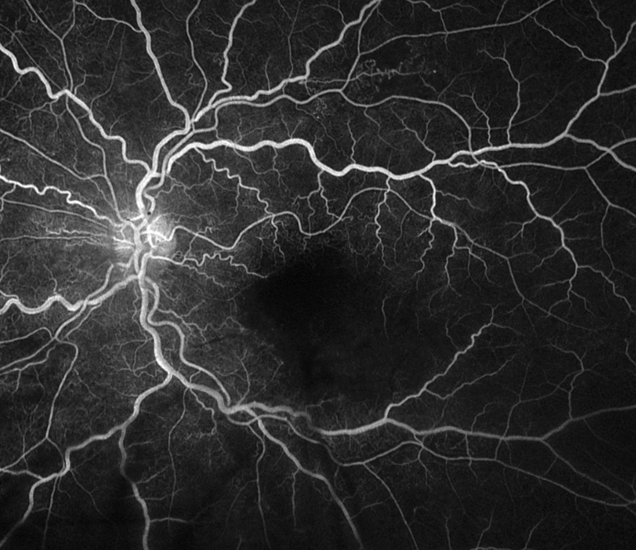 Syphilitic Retinal Vascular Disease | New Retinal Physician